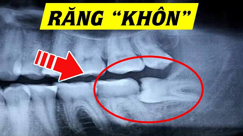 Răng số 8 là gì? Có nên nhổ răng số 8 không và lưu ý khi nhổ