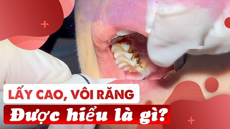 Lấy vôi răng là gì? Cách bảo vệ sức khỏe răng miệng